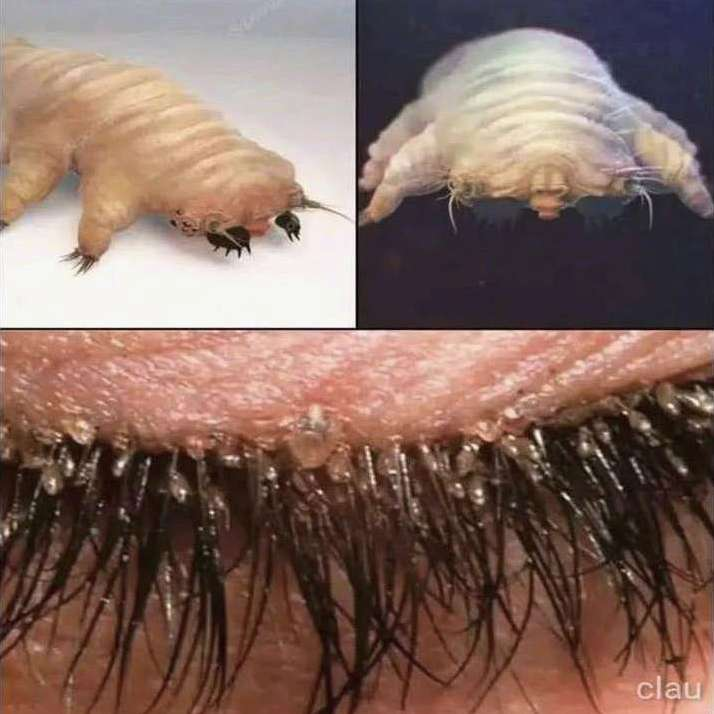 Eyelash Infection: Causes, Symptoms, and Treatment - Amazing
